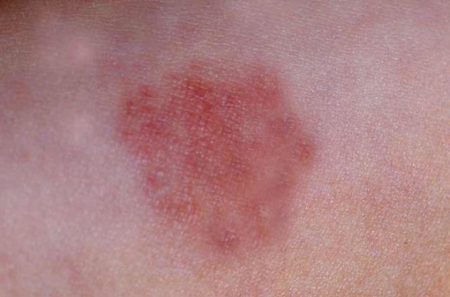 Bed Bug Rash on Skin, Pictures, Treatment, Allergy & Symptoms | Pestbugs