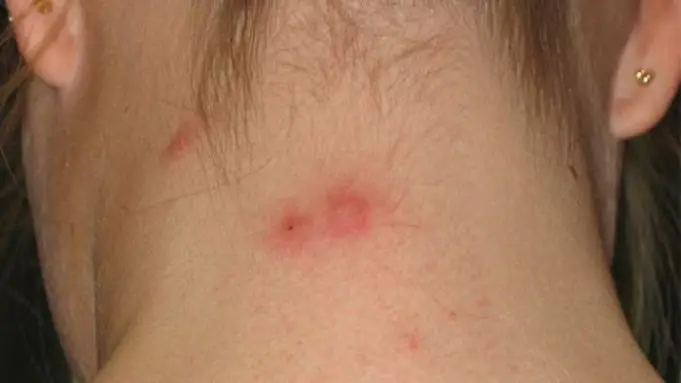 Earwig Bites: Dogs, Humans, Marks &How to Treat | Pestbugs