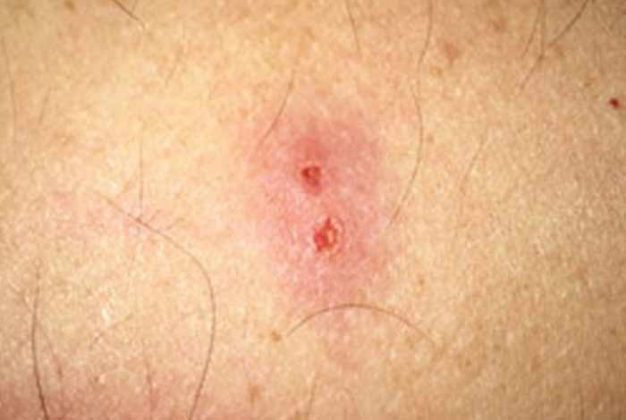 Mosquito Bite vs Spider Bite: Differences & Similarities | Pestbugs